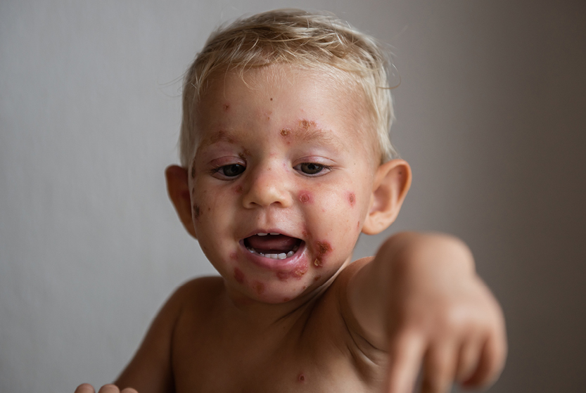 Impetigo – Bacteriële huidinfectie - Krentenbaard l Medibib